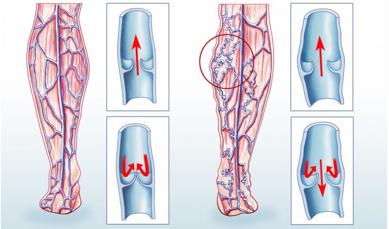 Varices des membres inférieurs – Cabinet Chirurgical